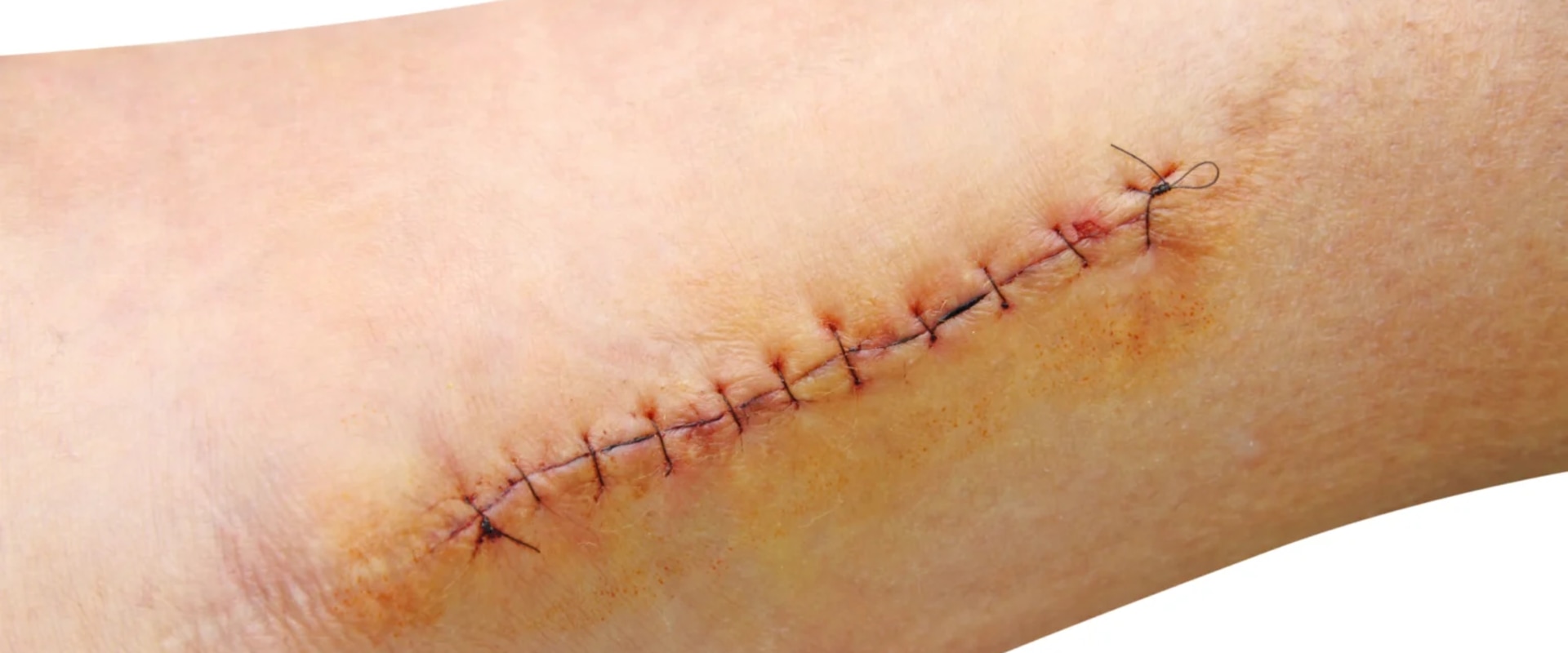 Caring for Healing Wounds: What Do Dissolvable Stitches Look Like and ...