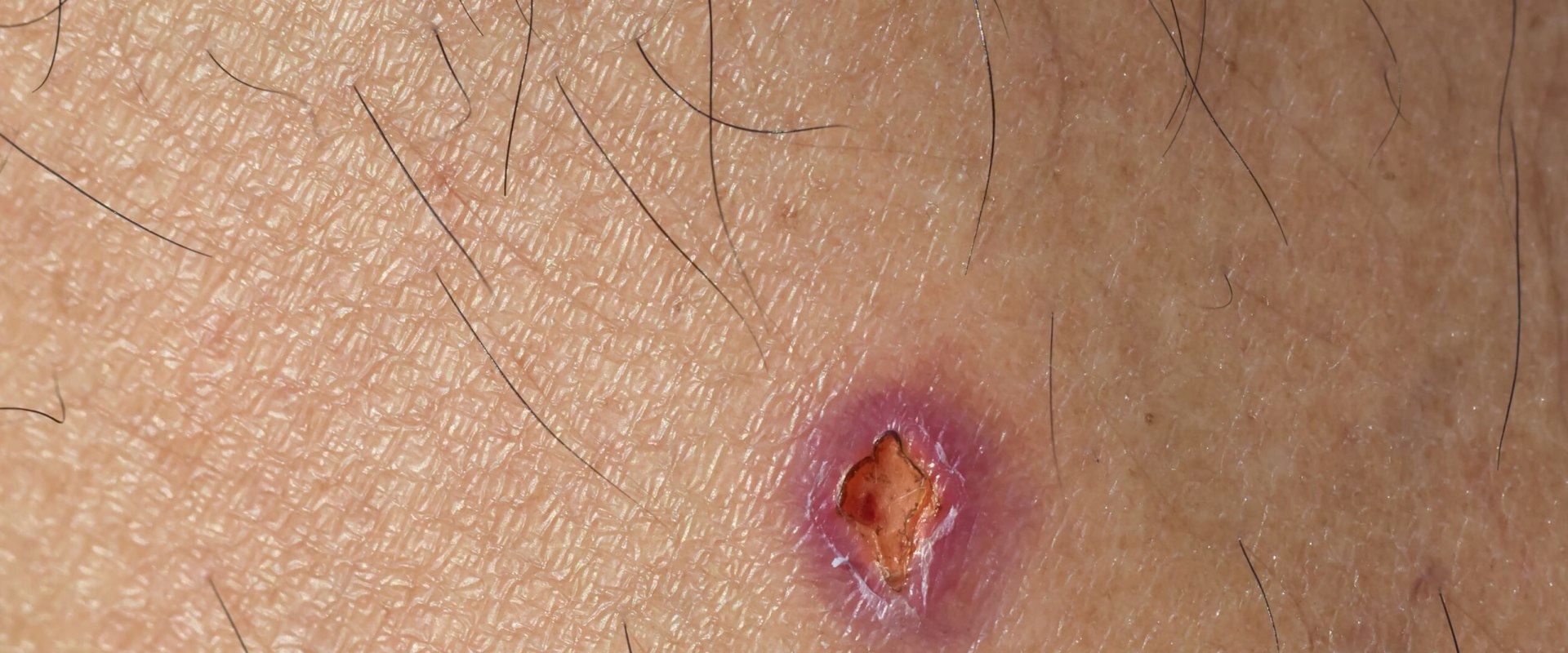 Granulation Tissue Wound Pictures That Highlight Recovery ...