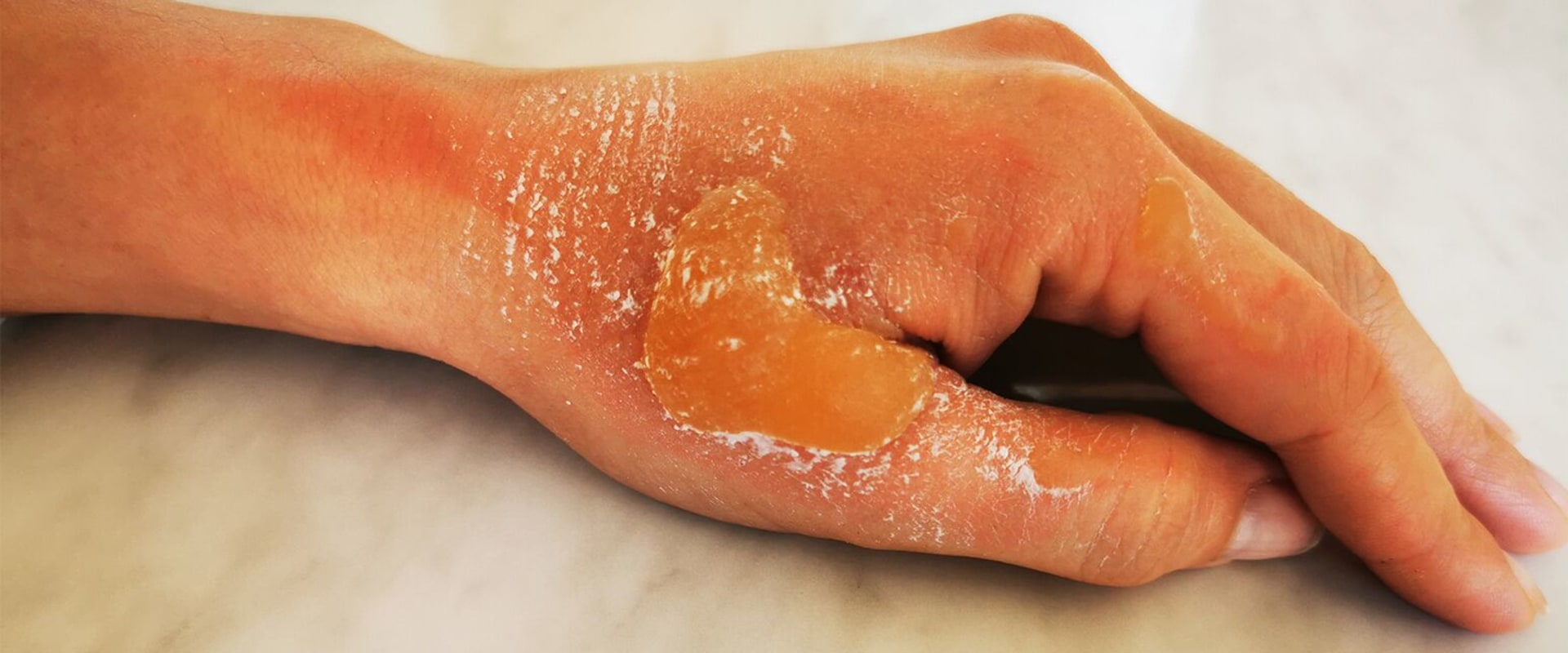 Wound Care Specialist Strategies For Managing First Degree Chemical ...