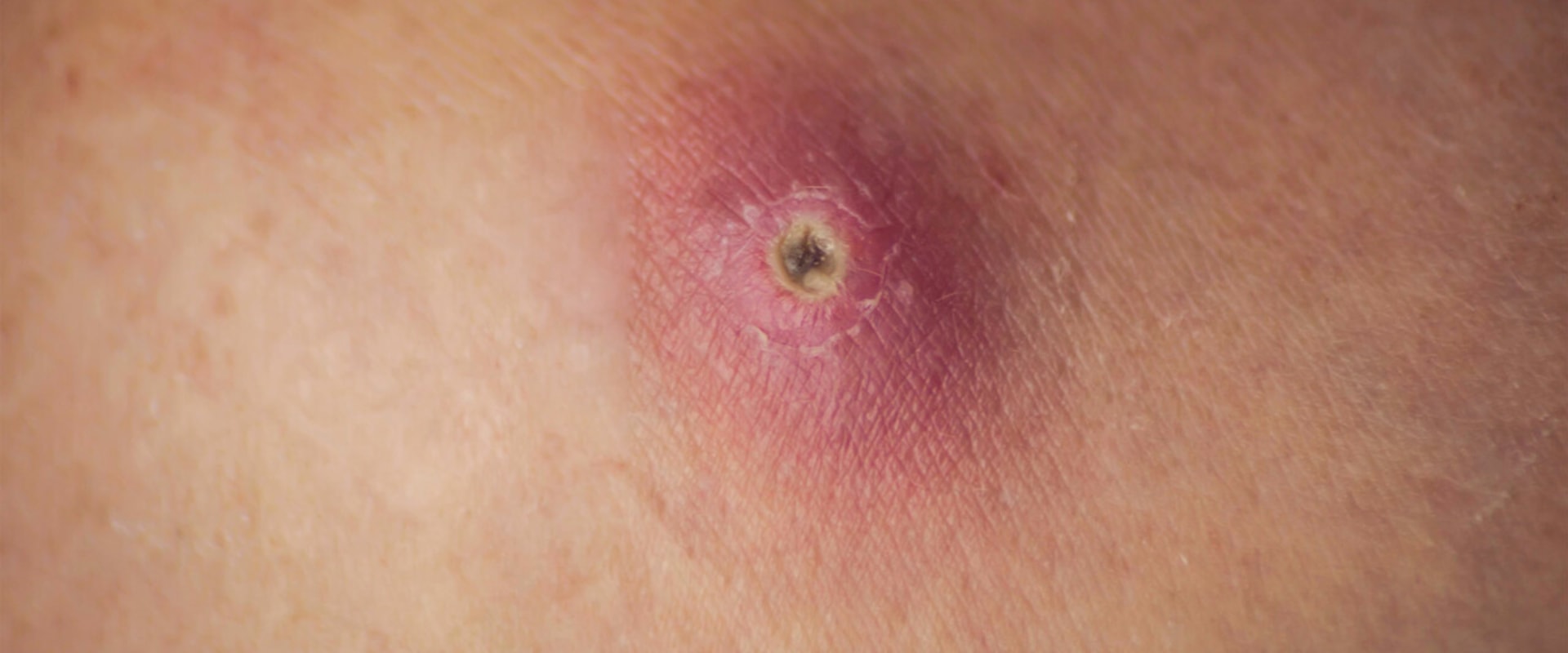 Boil vs Cyst vs Abscess: Key Signs and When to Act Fast