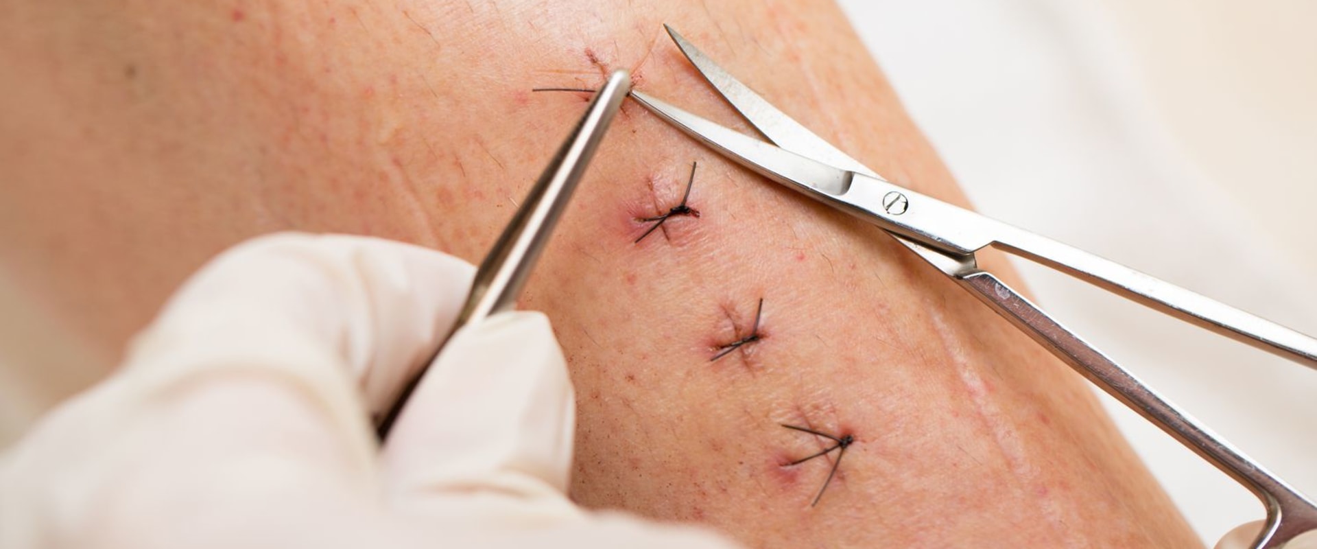 Effective Strategies For Denuded Skin Wound Care By Leading Specialists
