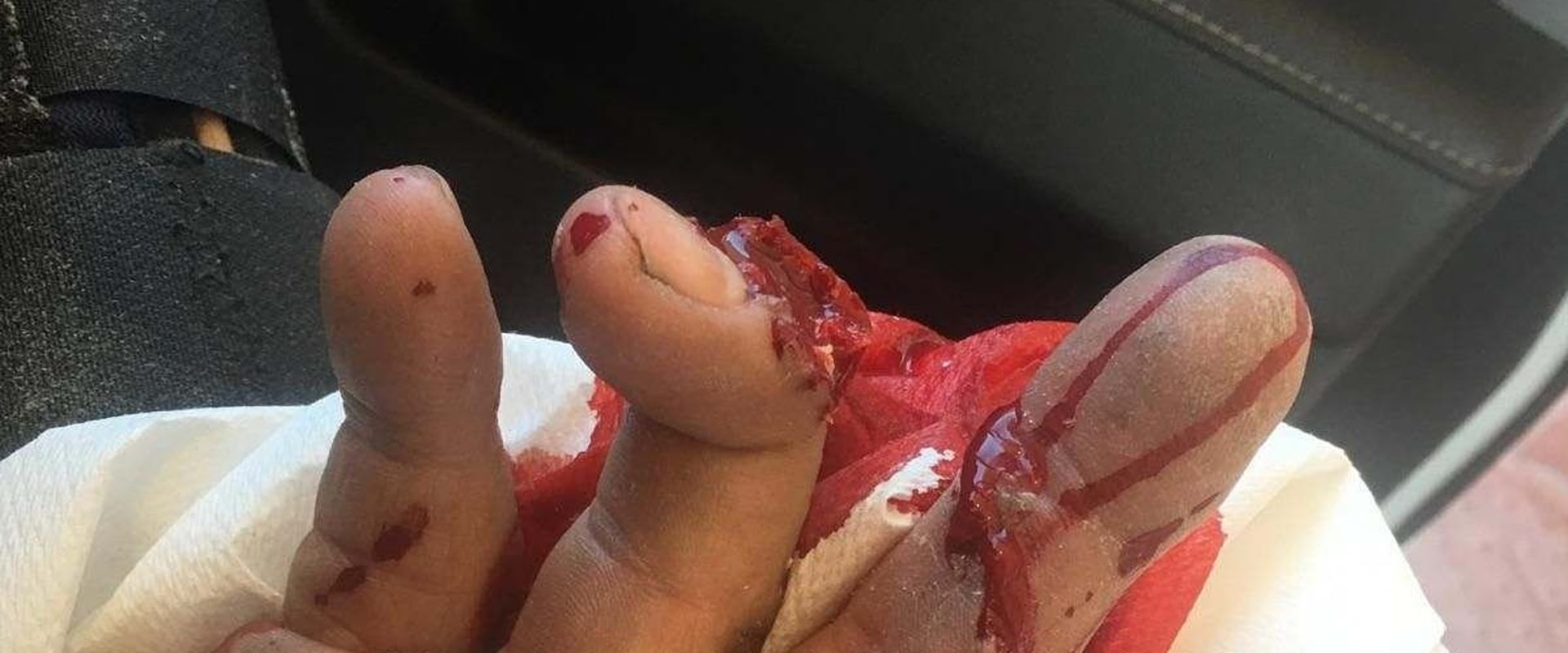 How to Treat a Skin Avulsion Wound on Finger Safely at Home